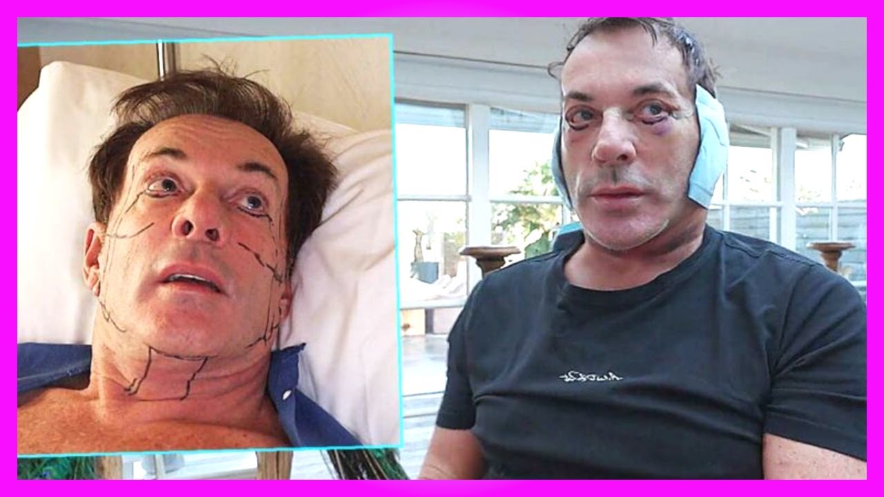 Gaat helemaal mis: Gerard Joling nauwelijks nog herkenbaar na operatie ...